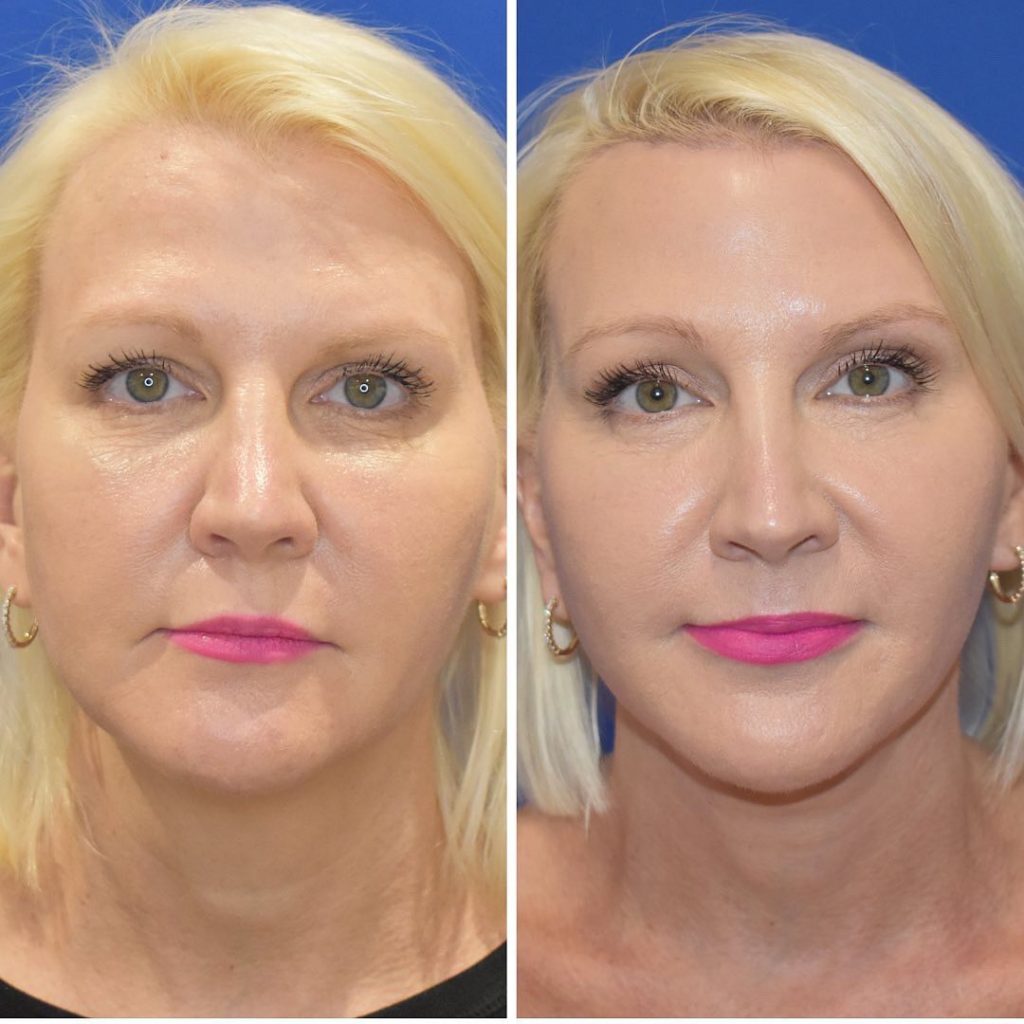 Best Facelift Austin, TX | Facial Plastic Surgery of Austin | Dr. Indeyeva