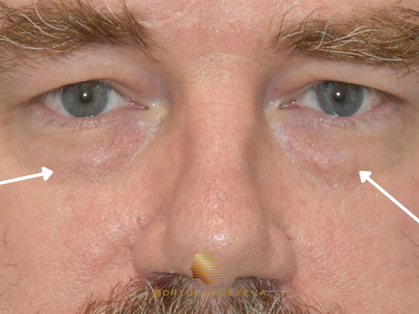 Lower Blepharoplasty Case 2625 - Facial Plastic Surgery Of Austin