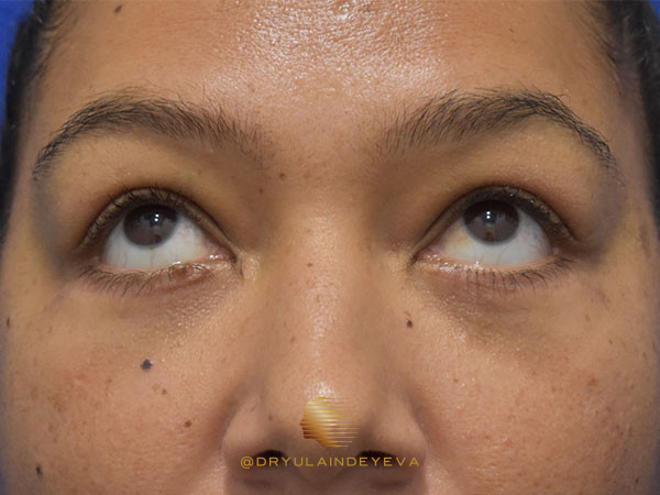 Lower Blepharoplasty Case 2725 - Facial Plastic Surgery Of Austin