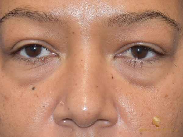 Lower Blepharoplasty Case 2725 - Facial Plastic Surgery Of Austin