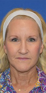 Extended Deep Plane Facelift Before & After Austin, TX | Near Me