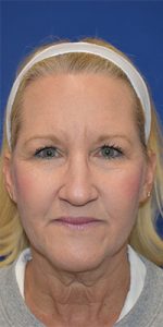 Extended Deep Plane Facelift Before & After Austin, TX | Near Me