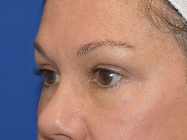 Brow Lift Case 4836 - Facial Plastic Surgery Of Austin
