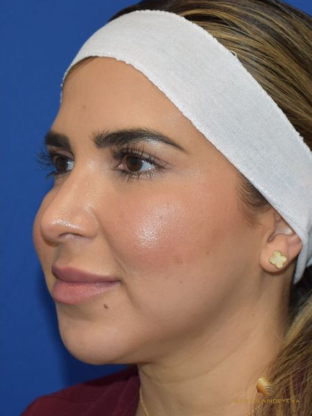 Buccal Fat Removal Case 4935 Facial Plastic Surgery Of Austin