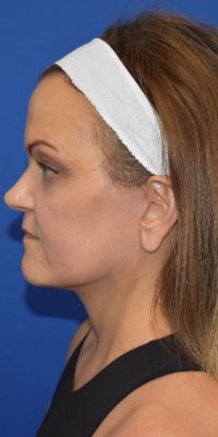 Extended Deep Plane Facelift Case 5034 - Facial Plastic Surgery Of Austin