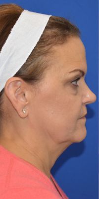Extended Deep Plane Facelift Case 5034 - Facial Plastic Surgery Of Austin