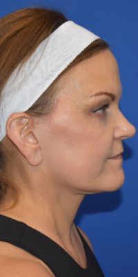Extended Deep Plane Facelift Case 5034 - Facial Plastic Surgery Of Austin