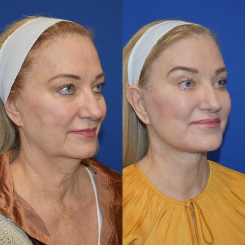 Best Facelift Austin, TX | Facial Plastic Surgery of Austin | Dr. Indeyeva