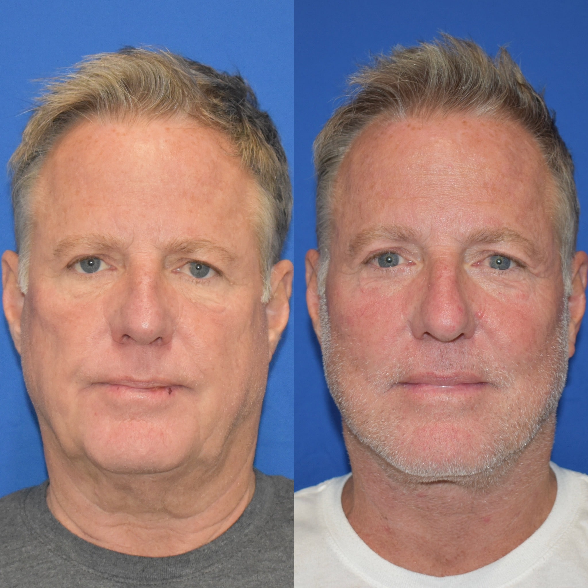 Extended Deep-Plane Facelift for Men Austin, TX | Dr. Indeyeva